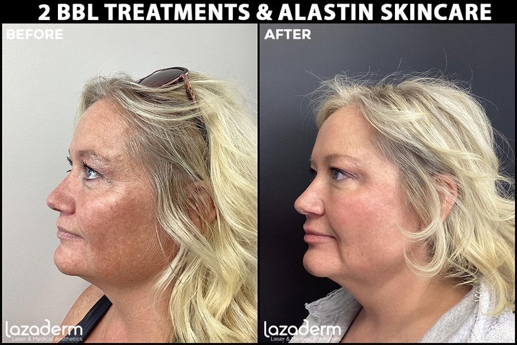 Before & Afters of BOTOX, Filler, CoolSculpting & More